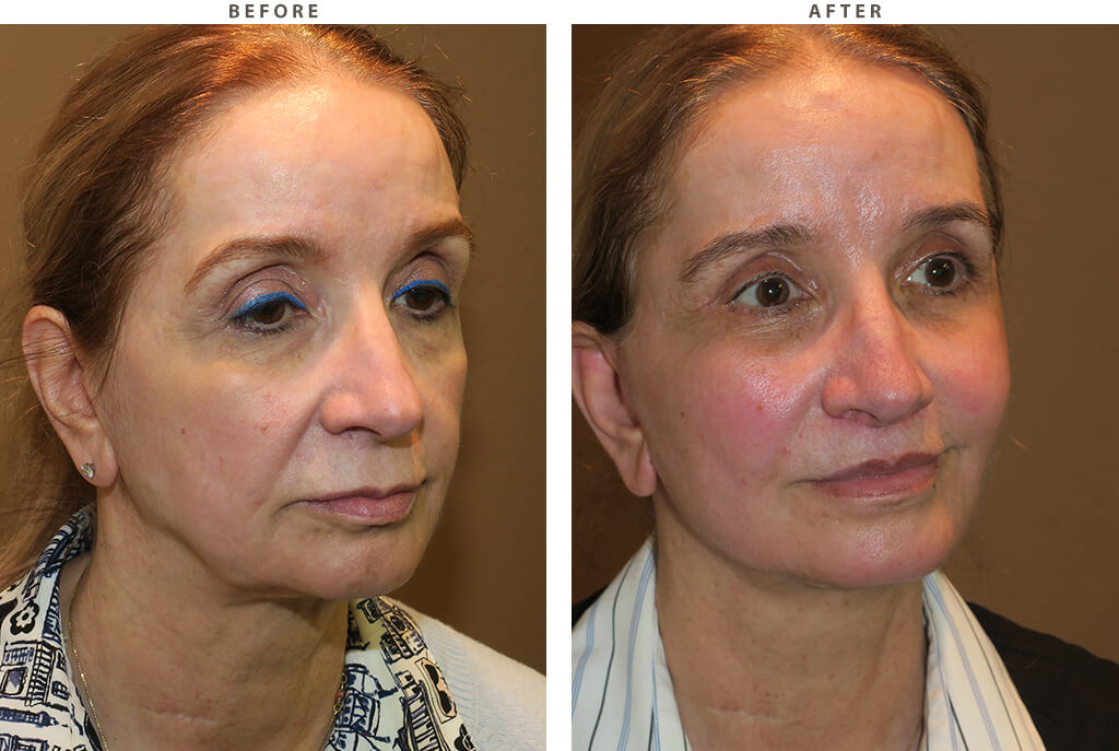 Before and after pictures - Complex facial rejuvenation - Chicago Face ...